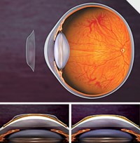 Corneal Refractive Therapy Crt Summit Vision Care
